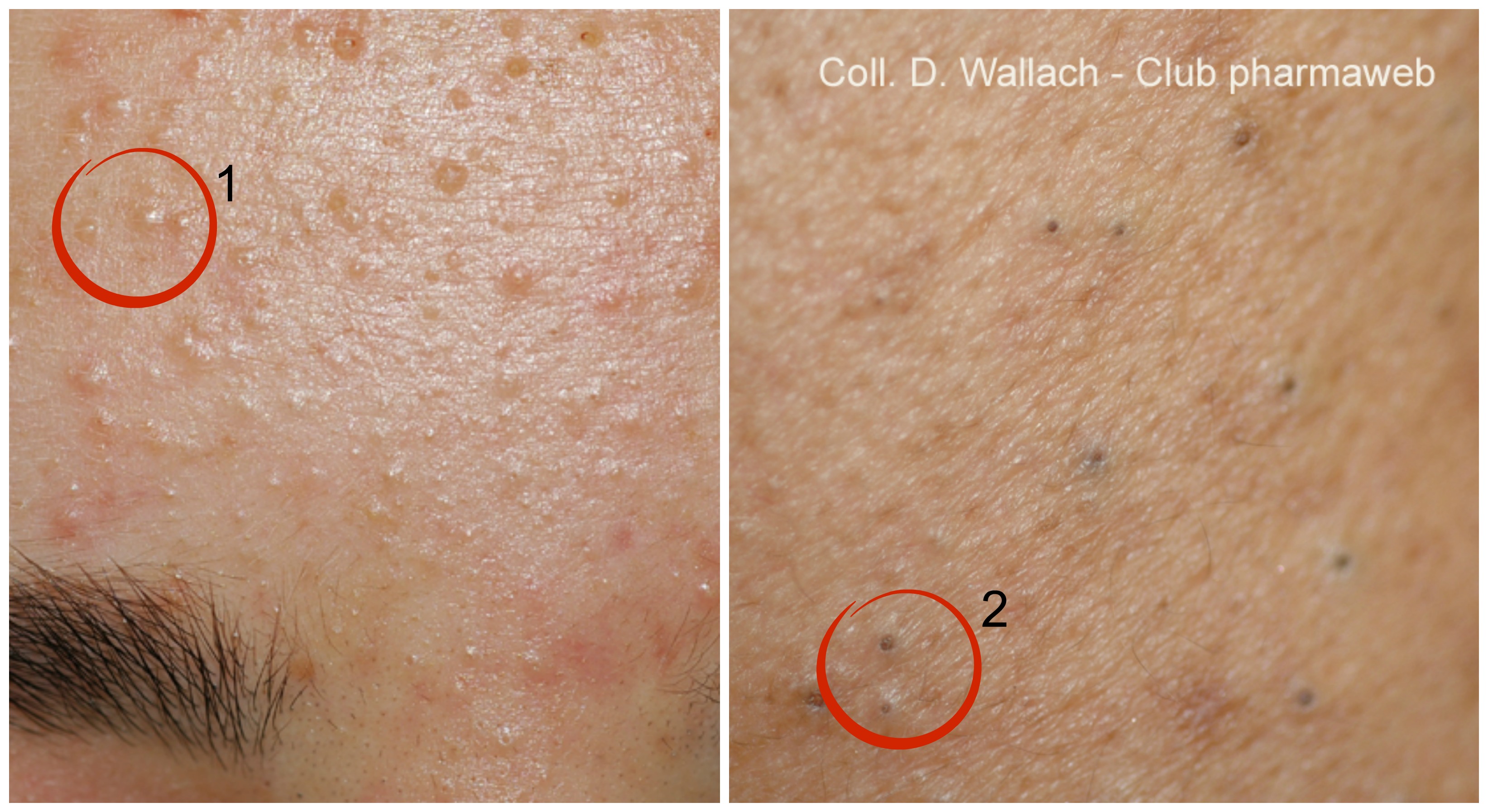 ¿Cómo reconocer las diferentes lesiones de acné? - El Blog de ...